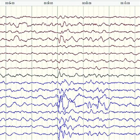 Eeg Showing Spikes And Spike Slow Wave Complex In The Right Hemisphere