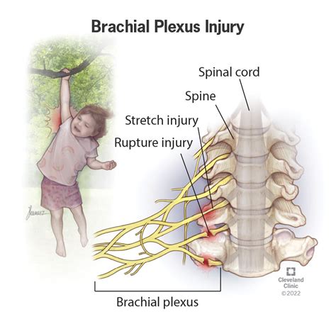 Brachial Plexus Injury Hiểu Biết Cơ Bản Ví Dụ Và Cách Sử Dụng