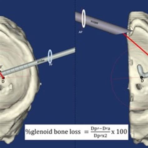 Schematic Quantification Of Glenoid Bone Loss By Arthroscopic Bare Download Scientific Diagram