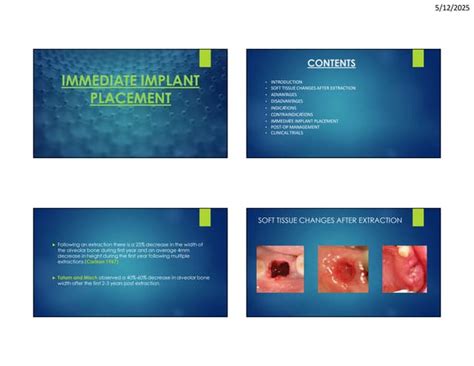 Immediate Implant 1pdf Prosthetic Treatment Pdf