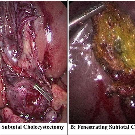 Subtotal Cholecystectomies A Reconstituting Subtotal Cholecystectomy Download Scientific