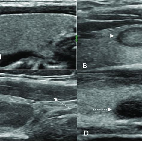 Solid Nodule Tr3 Tr4 Distribution Regarding Echogenicity And