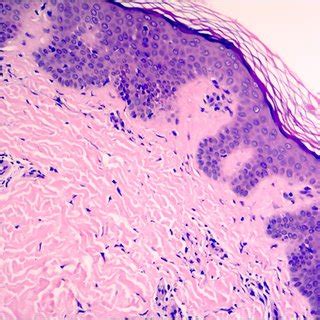 Lupus Pernio Histology