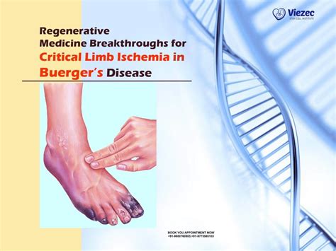 Regenerative Medicine Breakthroughs For Critical Limb Ischemia