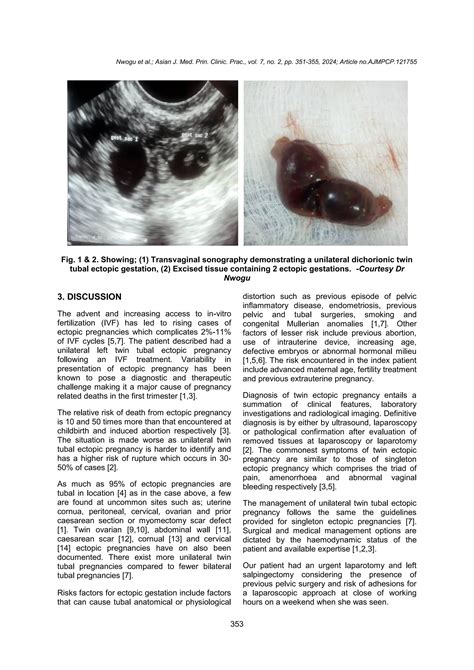 Unilateral Dichorionic Twin Tubal Ectopic Pregnancy Following Fresh In