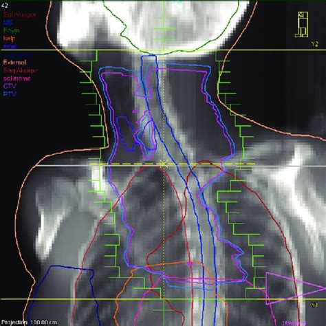 Digitally Reconstructed Radiograph Image Of The Radiotherapy Field From