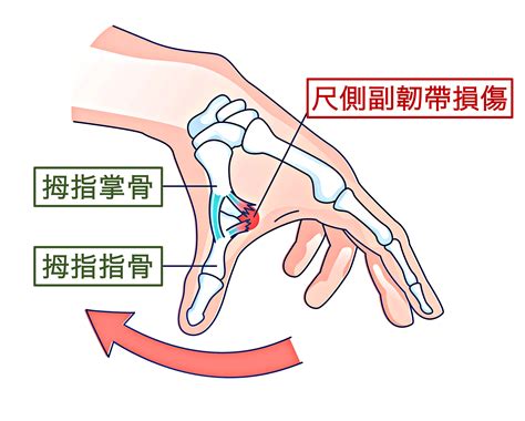 拇指尺側副韌帶損傷 Thumb Ucl Injury｜手部疾病專欄 手外科醫師