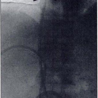 Pdf Experience With Tunneled Femoral Hemodialysis Catheters