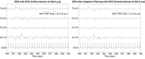 Multimodality Monitoring And Artificial Intelligence Neupsy Key