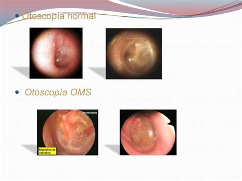 Otitis Media Serosa Pptx