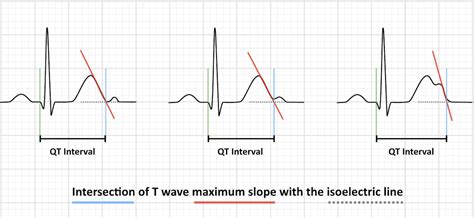 QT Interval LITFL ECG Library Basics