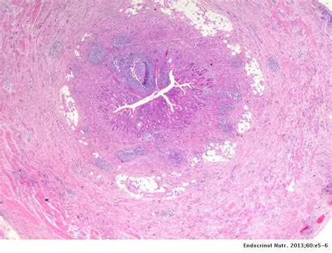 Goblet Cell Carcinoid Of The Appendix Endocrinología Y Nutrición