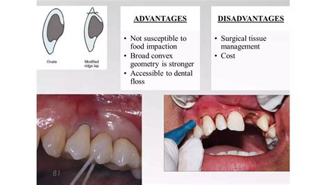 Pontics In Fixed Partial Denturepptx