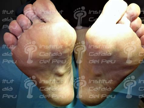 La Enfermedad De Ledderhose O Fibromatosis Plantar Icp