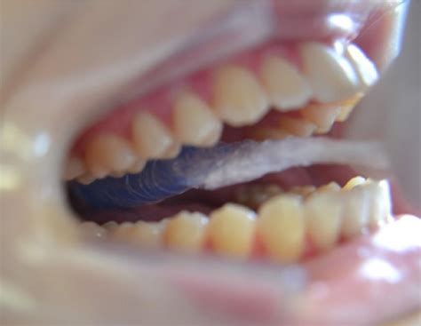 Posterior Tongue Pressure Measurement Download Scientific Diagram