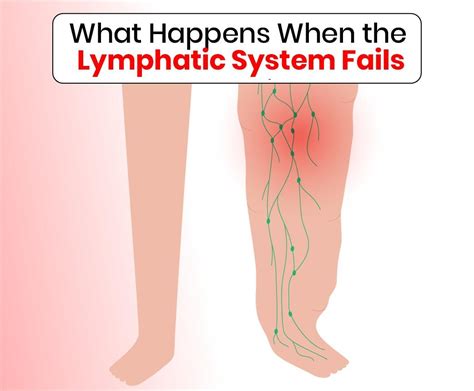 What Happens When The Lymphatic System Fails