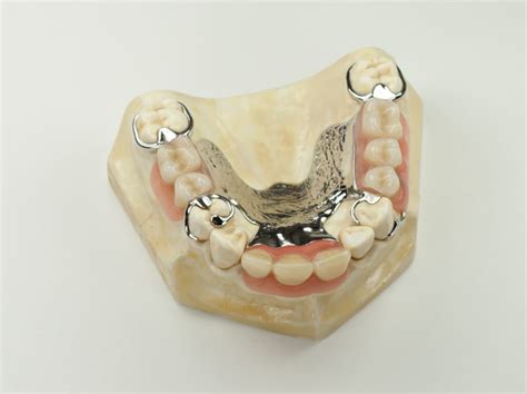 What Is Cast Partial Denture Globaldentalpro