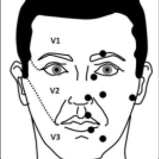 Trigeminal Neuralgia Trigger Points
