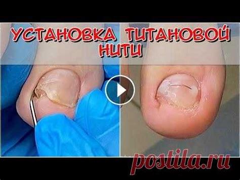 Установка титановой нити/#подология /#Вросший ноготь /Врос на ноге что ...