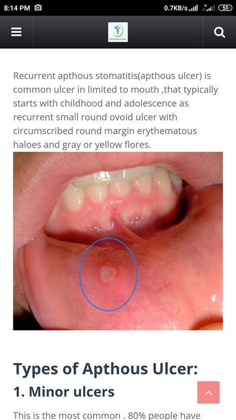 Recurrent Stomatitis Or Apthous Ulcer Type Cause And Treatment Of Apthous Ulcer By Noman