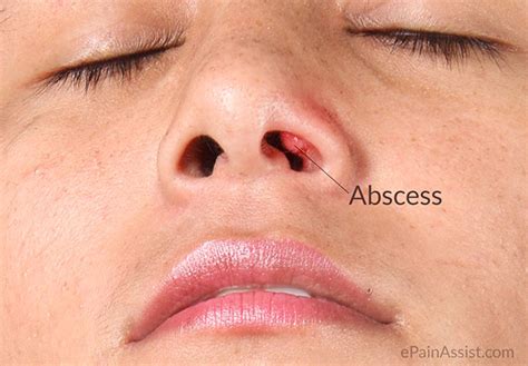 Nasal Vestibulitistreatmentcausessignssymptomsrisk Factors
