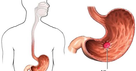 Peptic Ulcer Treatment Approach Medical And Surgical