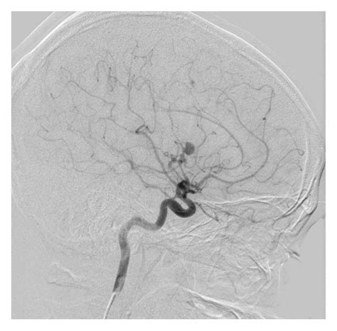 Lateral View Of Cerebral Angiographic Dsa Image Demonstrating An 8 Mm Download Scientific