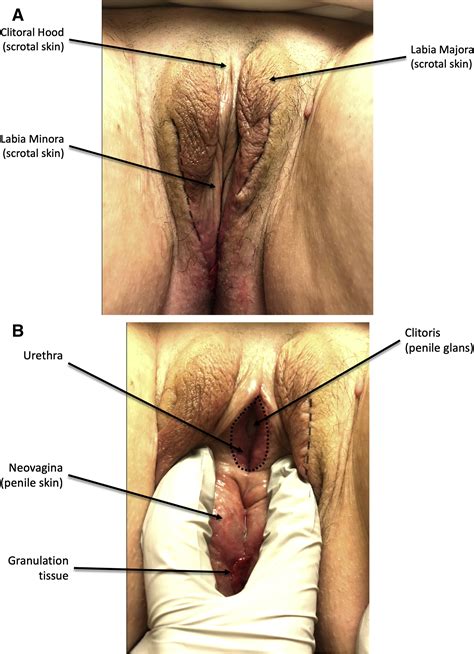The Gynecologic Examination Of The Transfeminine Person After Penile