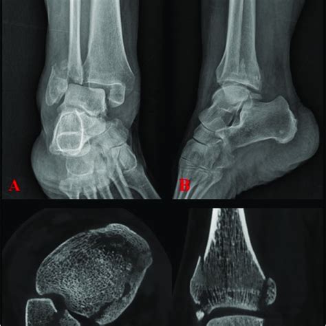 Bartoní9 Cek Classification A Type I Extraincisural Fragment With An