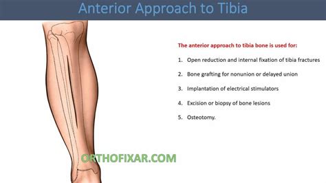 Anterior Approach To Tibia Bone Grafting Grafting Approach