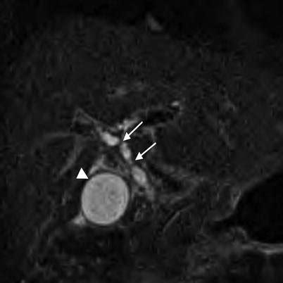 Primary Sclerosing Cholangitis A Coronal Thin Slab MRCP Images Show Download Scientific