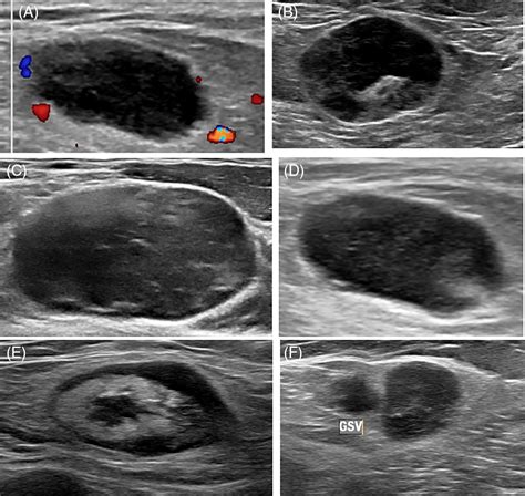 Sonographic Localisation And Description Of Inguinofemoral Lymph Nodes In Patients With Vulvar Sonographic Localisation And Description Of Inguinofemoral Lymph Nodes In Patients With Vulvar