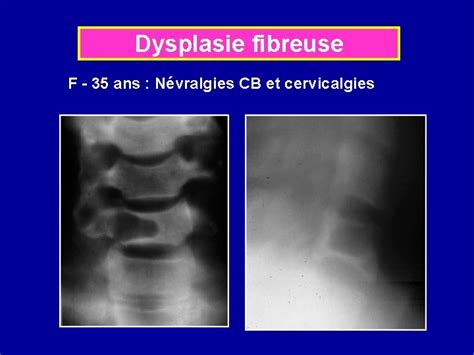 Dysplasie Fibreuse Et Fibrome Ossifiant Maladie De Jafflichtenstein