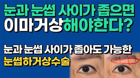 눈과 눈썹 사이가 좁으면 이마거상을 해야 한다 눈과 눈썹 사이가 좁아도 가능한 눈썹하거상수술 Youtube