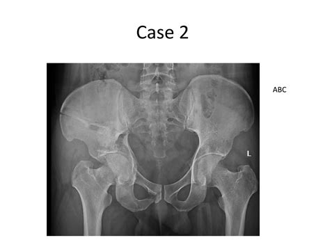 Imaging And Classification Of Acetabular Fracturespptx