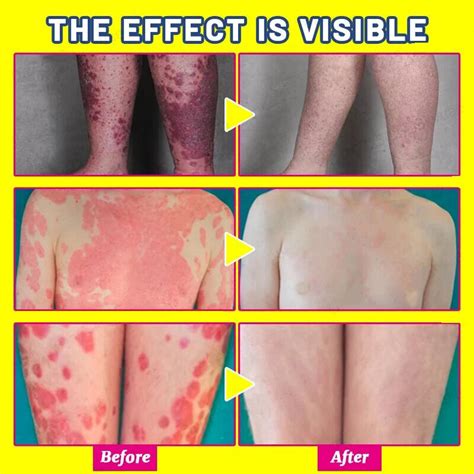 Psoriasis Cream Eczema Ointment Psoriasis Treatment Hand Tinea Foot