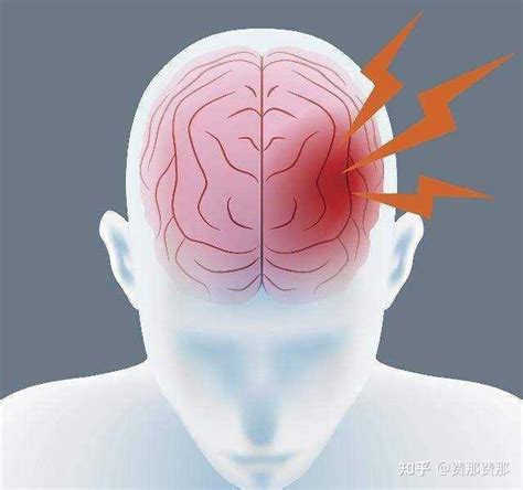 偏头痛是什么原因引起的？ 知乎