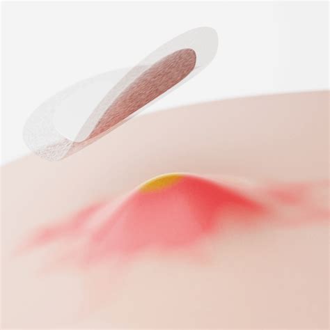 10 Powerful Reasons Why Pimple Patches Are The Best Quick Fix For Acne