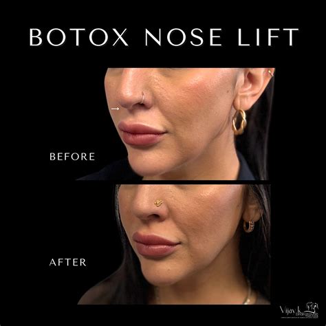 Meet The Botox Nose Lift 👃 What If We Told You That Botox Can Do More Than Smooth Wrinkles
