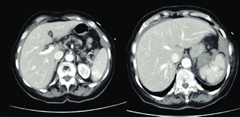 Pre Intervention Computed Tomography Of The Chest Abdomen And Pelvis