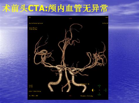 经左侧侧裂—岛叶基底节脑内血肿清除术1例 脑医汇 神外资讯 神介资讯