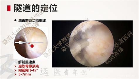 临床技术 四字位辅助内侧入路前交叉韧带单束重建技术 学术园地
