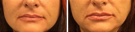How To Correct Uneven Lip Filler Infoupdate Org