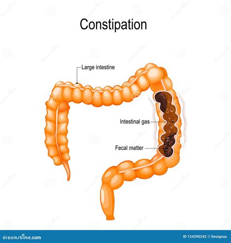 Constipation Human Large Intestine With Fecal Matter Stock Vector