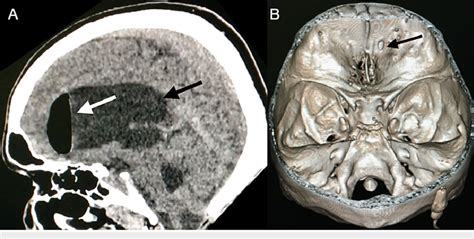 Computed Tomography A Ct Scan Of Skull Sagittal Showing