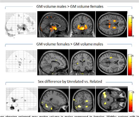 Figure 1 From Sex Differences In Gray And White Matter Structure In Age
