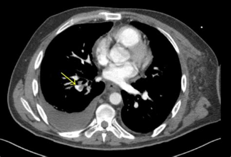 Pulmonary Embolism Clinical Concise Medical Knowledge
