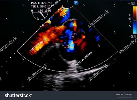 Transesophageal Echocardiogram Showing Color Flow Doppler Stock Photo Edit Now