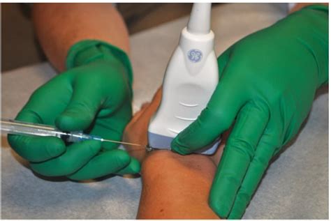 Third Dorsal Compartment Of The Wrist Injection Wikism Sports Medicine Wiki