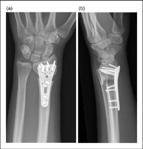Figure 1 From Corrective Osteotomy Of The Distal Radius With Palmar Locking Plate Osteosynthesis